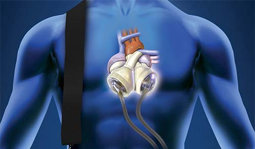 Advances in Pediatric Cardiology & Heart Surgery | NewYork-Presbyterian ...